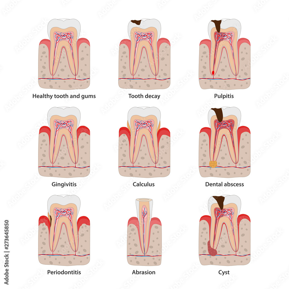 Popular teeth diseases icons in flat design, vector medical ...