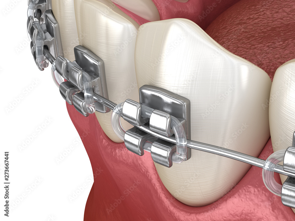 Healthy Teeth with metal braces, Macro view. Medically accurate dental ...