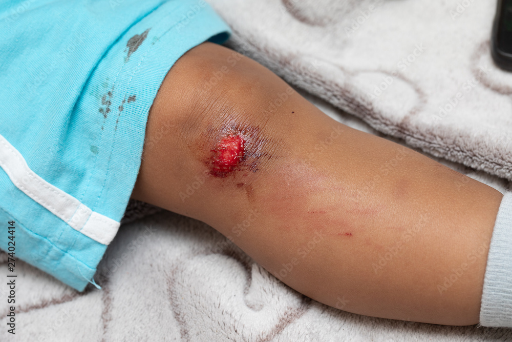 grazed knee