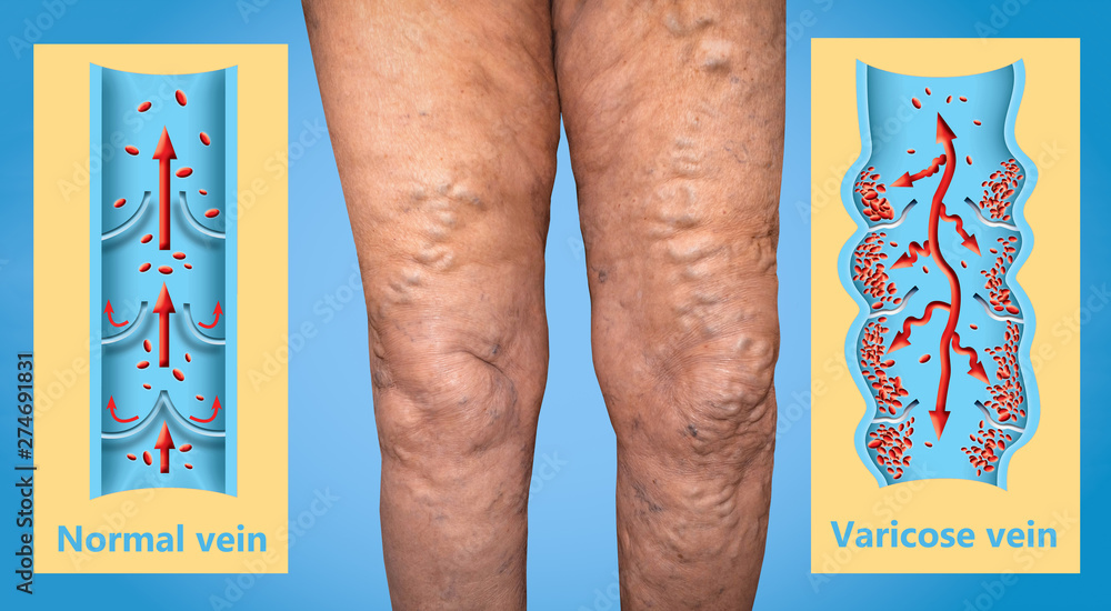 Varicose veins on a female senior legs. The structure of normal and ...