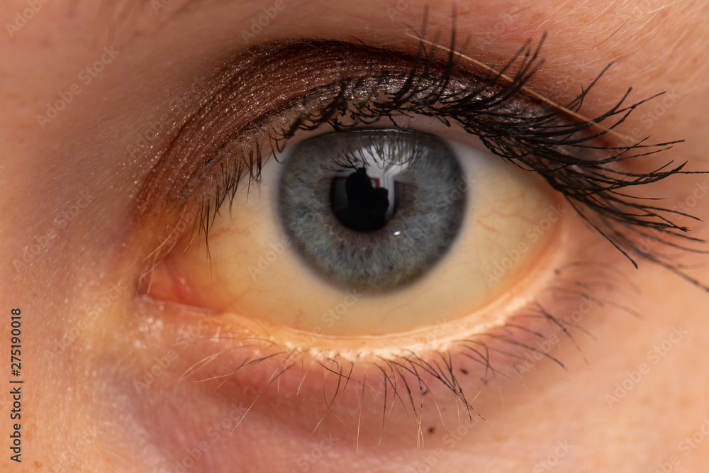 A closeup view on the eye of a young Caucasian adult with yellowing of ...