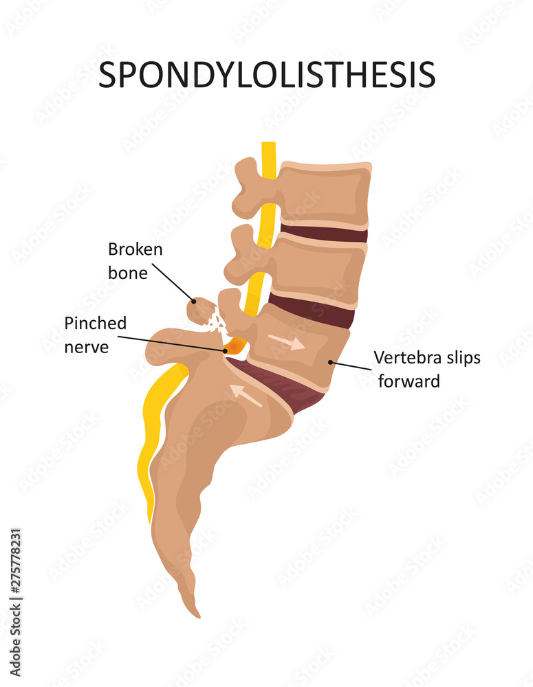 Spondylolisthesis. Pinched nerve Stock Vector | Adobe Stock