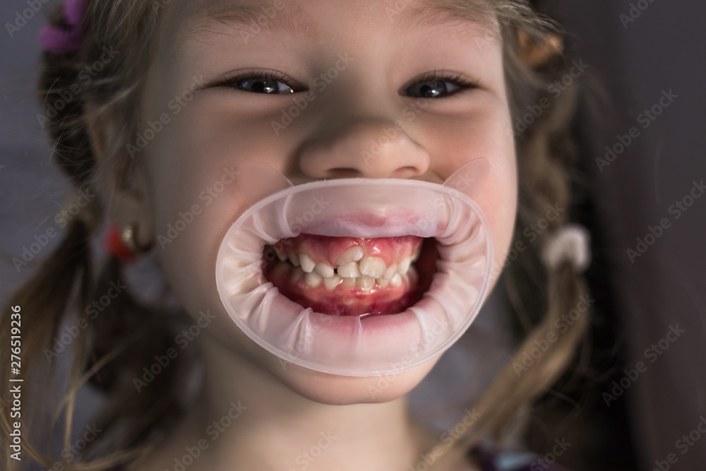 Adult permanent teeth coming in front of the child's baby teeth: shark ...