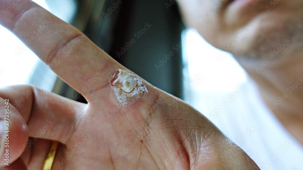Photo Stock wart on finger after treatment by salicylic acid. wart on ...