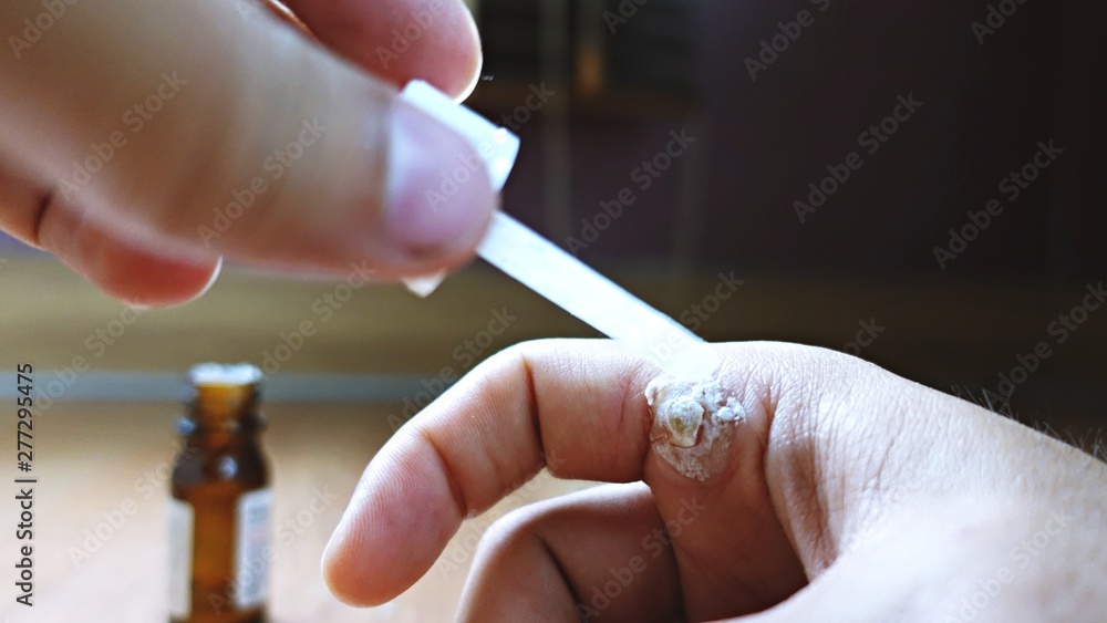 wart on finger after treatment by salicylic acid. wart on the finger ...