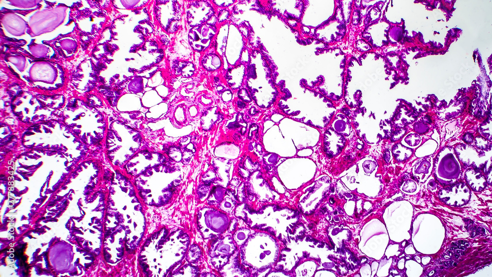 Histopathology of prostate gland hyperplasia, light micrograph, photo ...