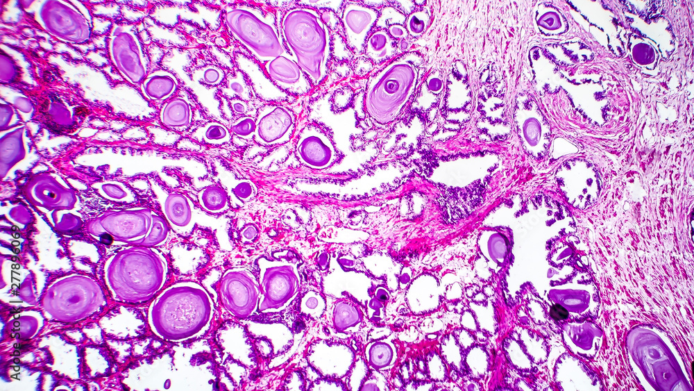 Histopathology of prostate gland hyperplasia, light micrograph, photo ...