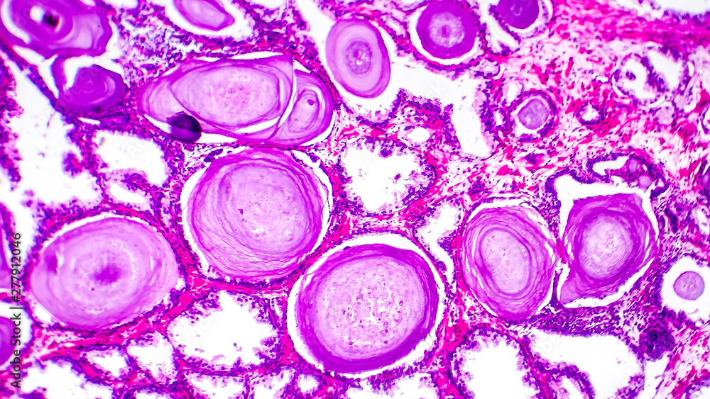 Histopathology of prostate gland hyperplasia, light micrograph, photo ...
