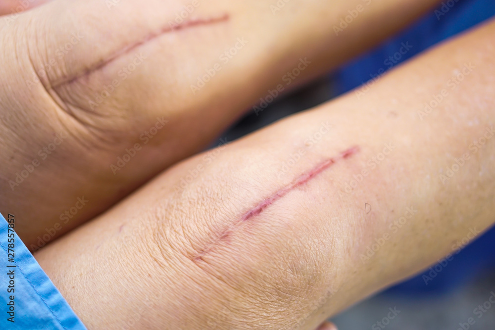 Asian senior or elderly old lady woman patient show her scars surgical ...