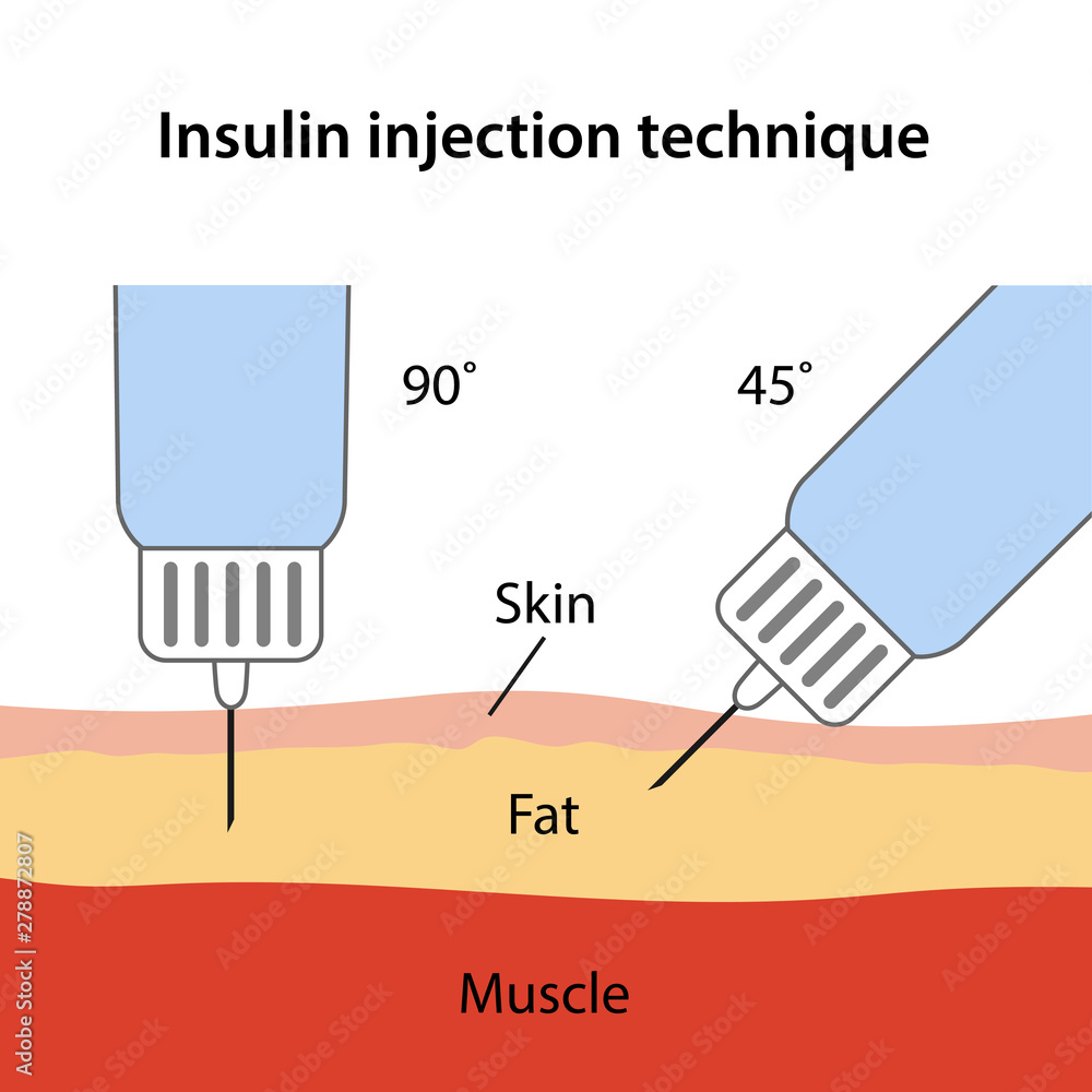 Insulin injection technique for diabetes depending on needle angle: 90 ...