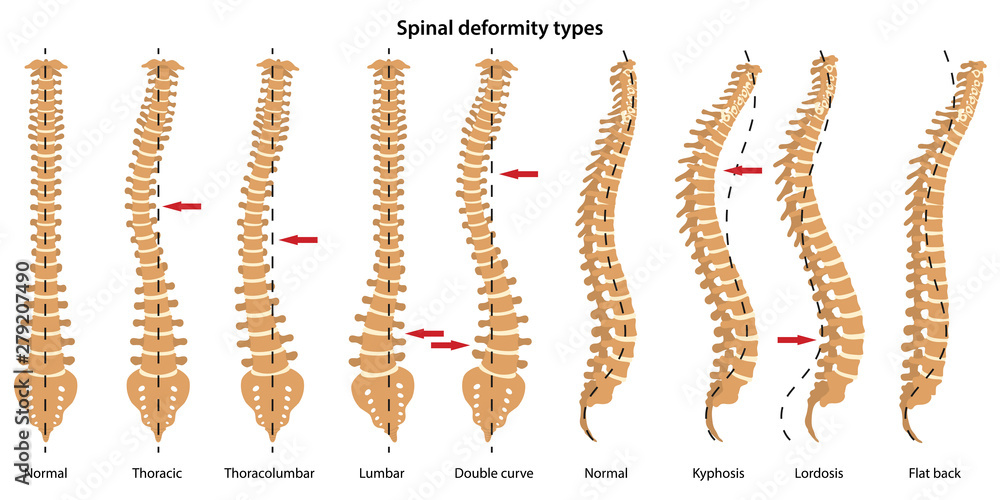 Spinal deformity types. Anterior view and lateral view of spinal ...