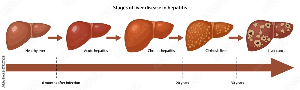 เวกเตอร์ Stock Stages of liver disease in hepatitis with description ...