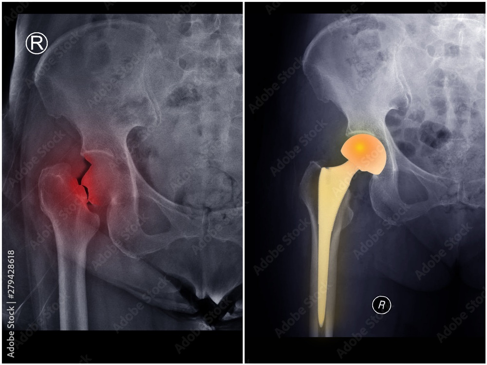 Film X-ray hip radiograph showing broken bone (fracture neck of femur ...