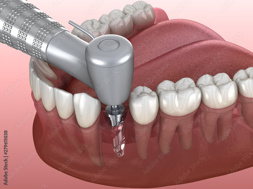 Drilling of bone while dental implant placement. Medically accurate 3D ...