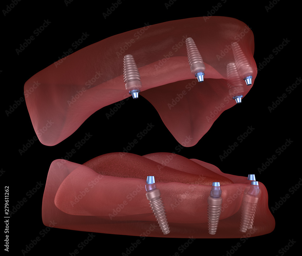 Maxillary and Mandibular prosthesis with gum All on 4 system supported ...