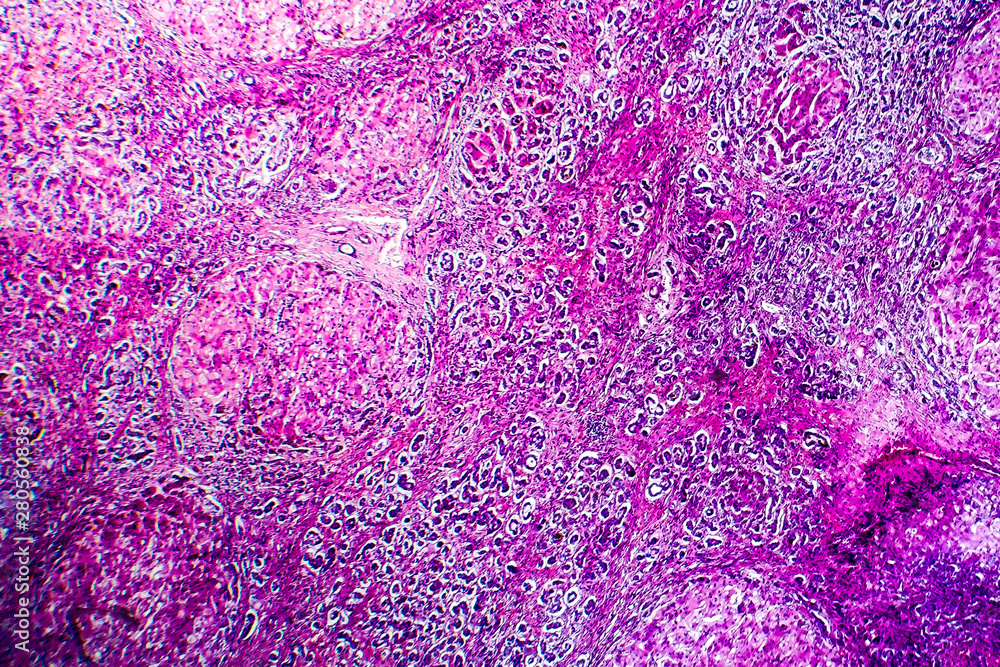 Histopathology of biliary liver cirrhosis, light micrograph, photo ...