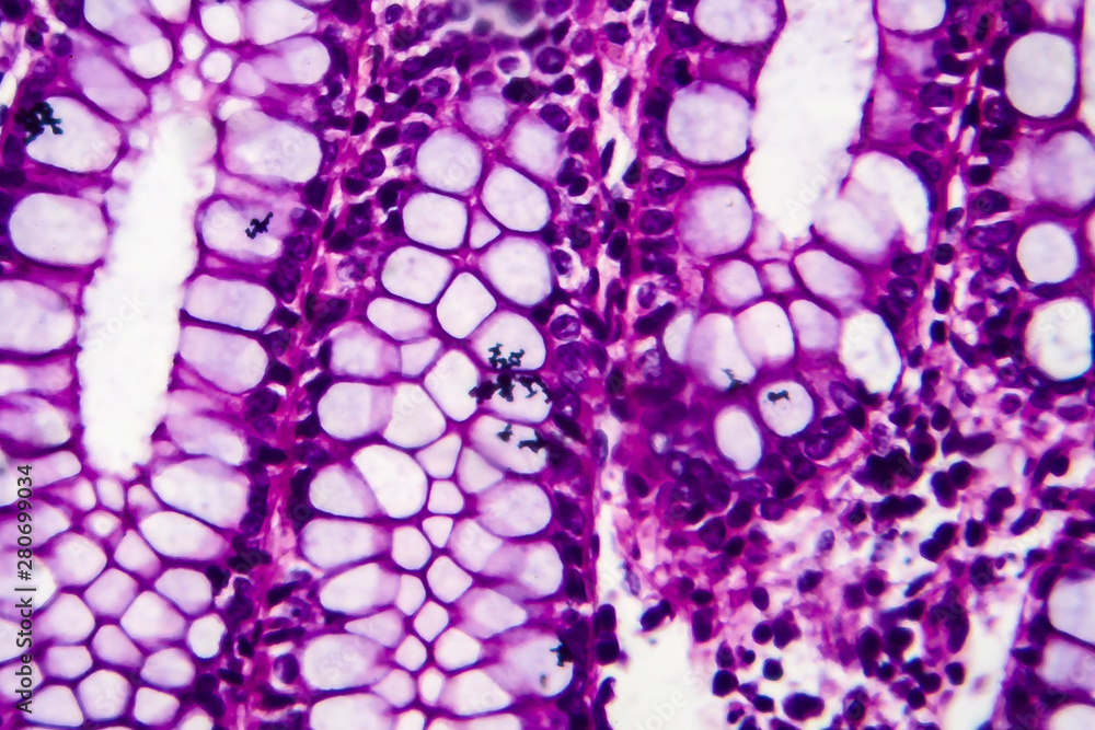 Bacillary dysentery, light micrograph, photo under microscope showing ...