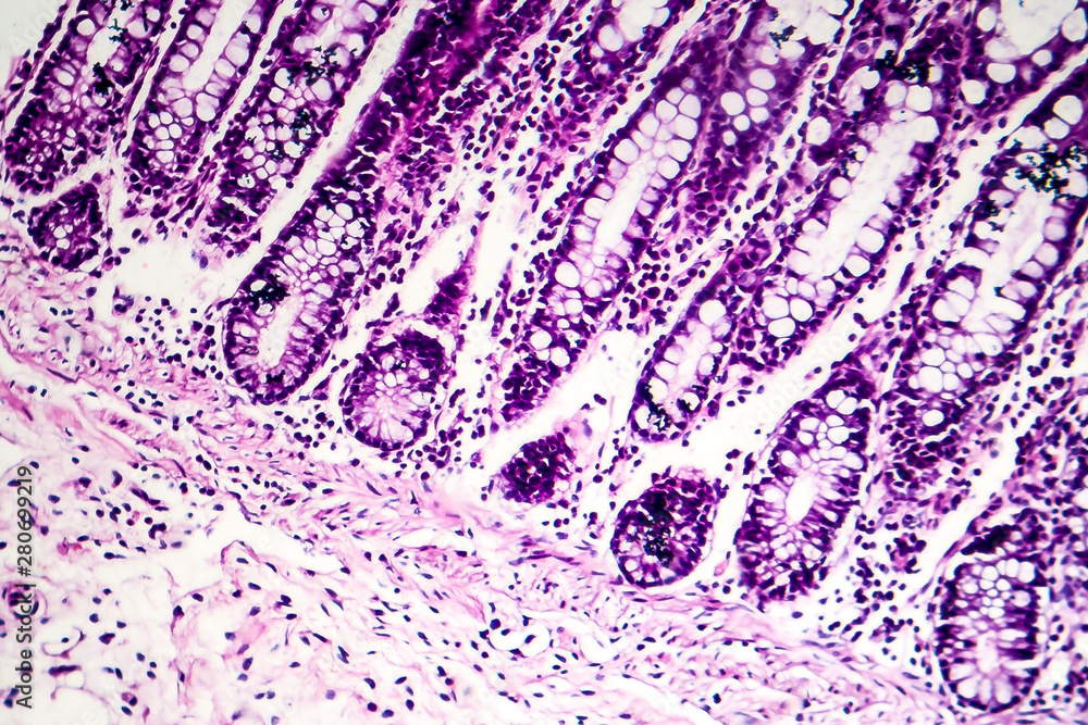 Bacillary dysentery, light micrograph, photo under microscope showing ...
