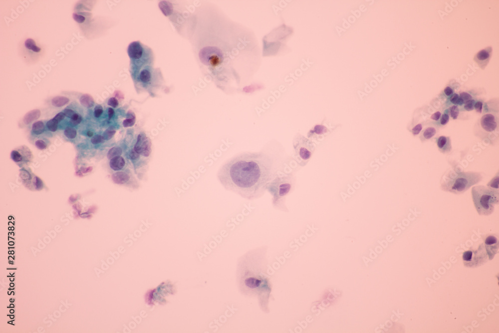 View in microscopic of abnormal human cervix cells.Squamous epithelium ...