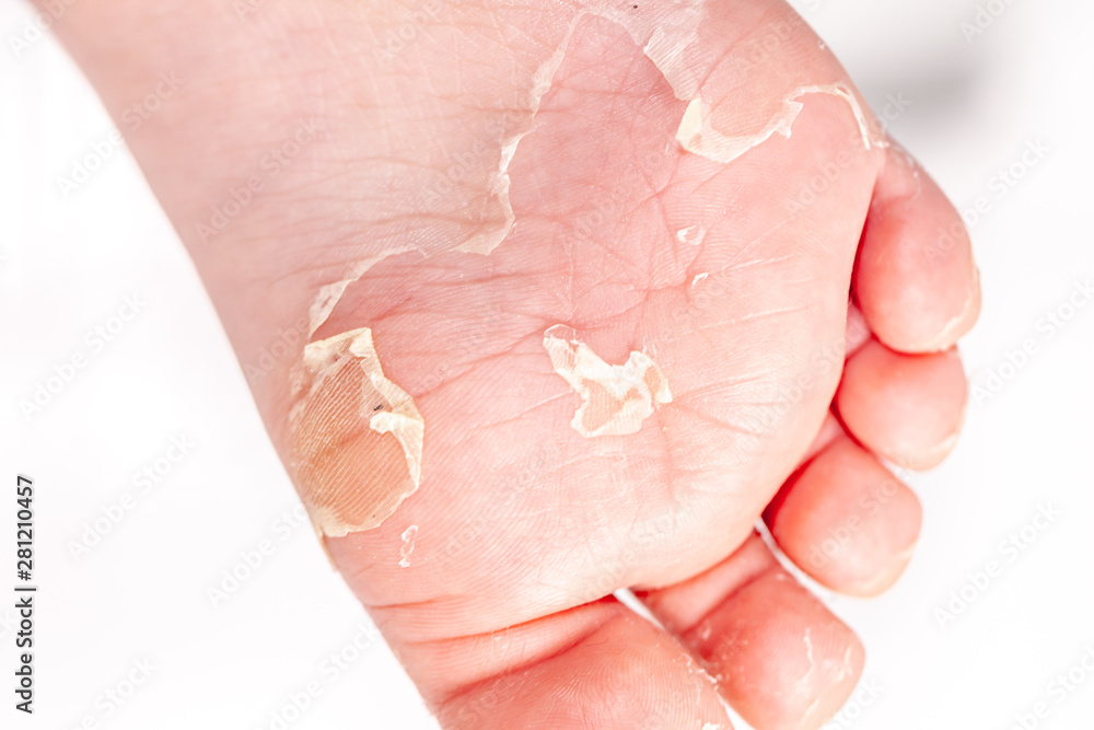 Foto de Stock After the red rash and the strawberry tongue caused by ...