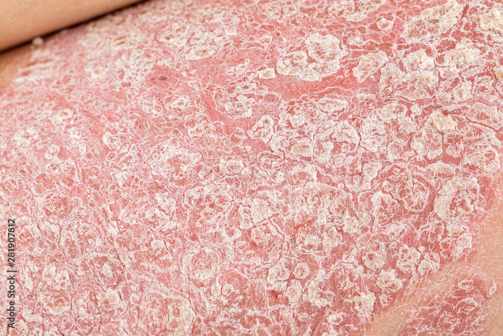 Man with sick hands, dry flaky skin on his hand with vulgar psoriasis ...