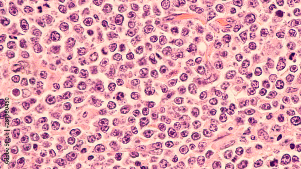 Lymphoma awareness: photomicrograph of a diffuse large B-cell lymphoma (DLBCL) a type of non ...