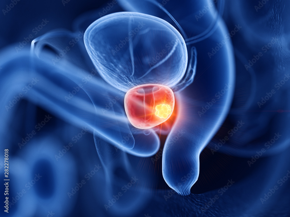 3d rendered medically accurate illustration of prostate cancer Stock ...