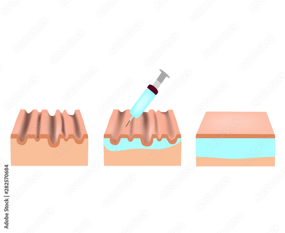Wrinkles on the skin. Botox wrinkle treatment. Anatomical skin ...
