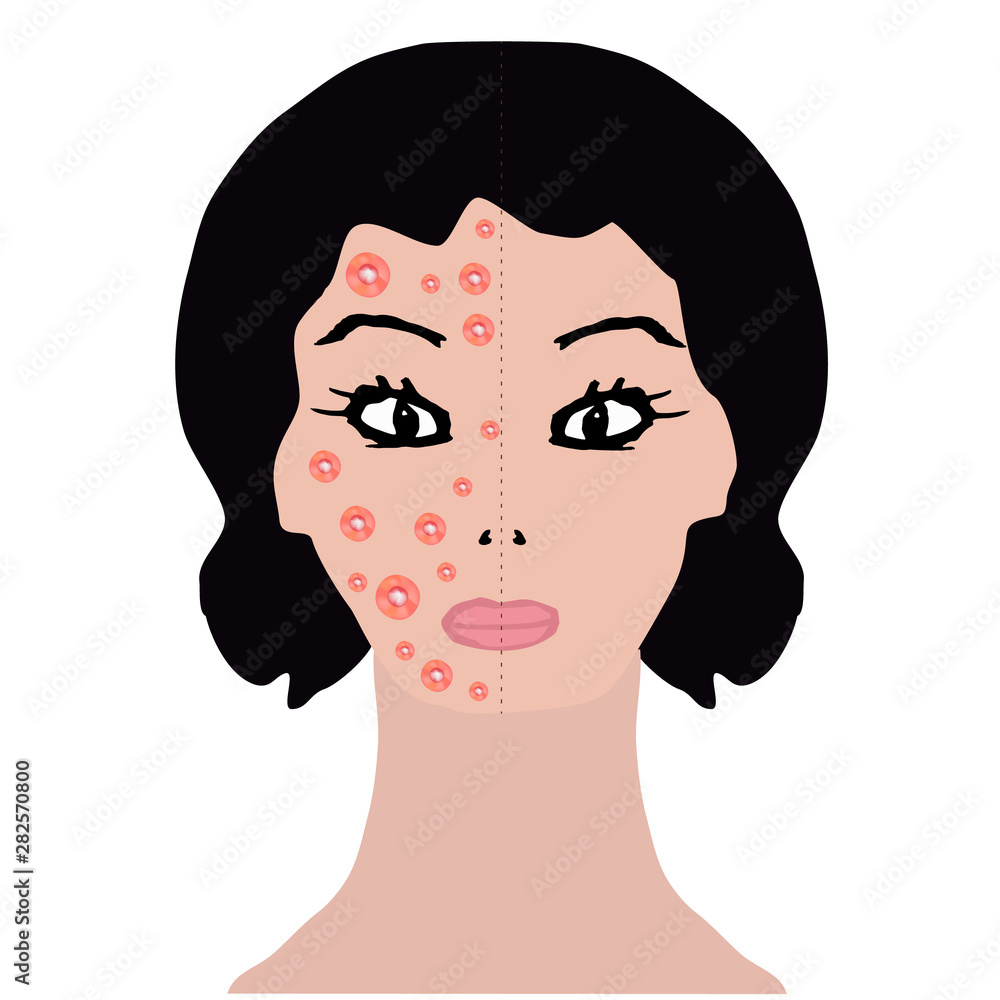 Rash on face. Allergy, dermatitis, acne, pimples. Infographics. Vector ...