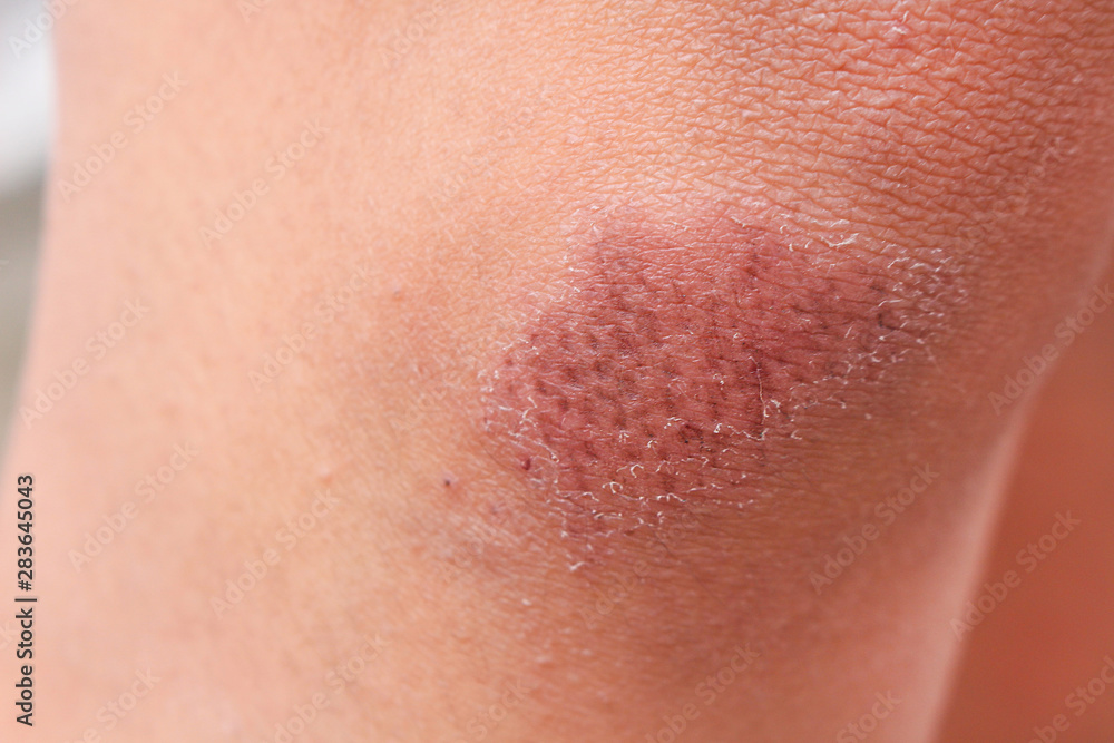 Bruise wounded texture on asian woman knee skin background Stock Photo ...