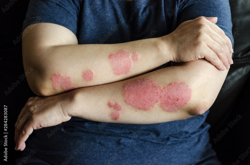 Dermatological skin disease. psoriasis, eczema, dermatitis, allergies ...