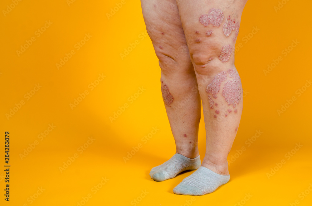 Dermatological skin disease. psoriasis, eczema, dermatitis, allergies ...