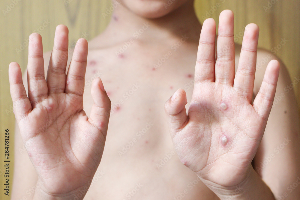 Chicken pox rash on young boy body.Chickenpox is an infection caused by ...