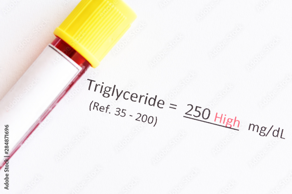 Blood sample with abnormal high triglyceride test result Stock Photo ...