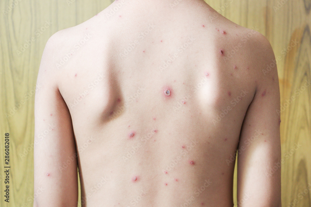 Chicken pox rash on young boy body.Chickenpox is an infection caused by ...