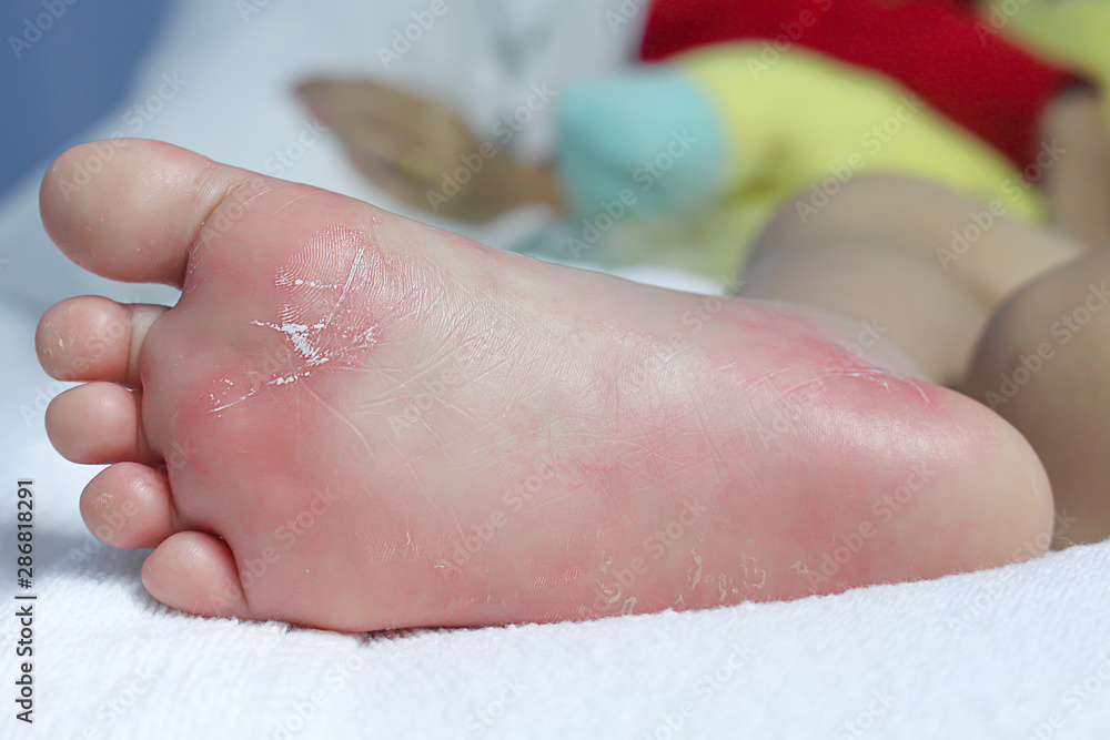 Asian child girl 's right foot have red rash and swelling from a bee ...