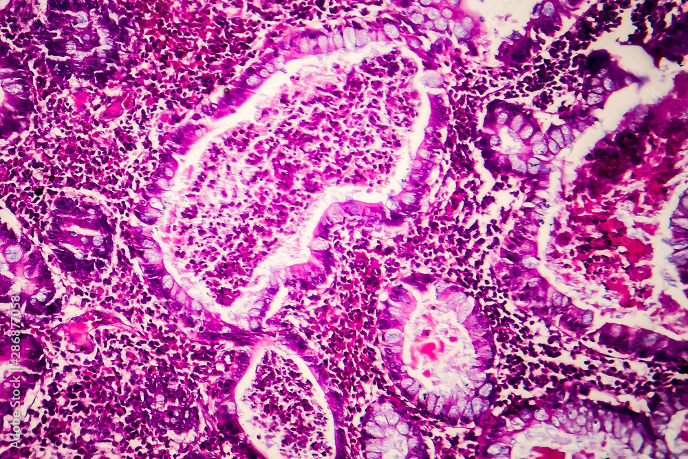 Villous colon adenocarcinoma, light micrograph, photo under microscope ...