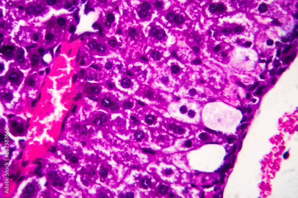 Histopathology of acute hepatitis, light micrograph, photo under ...