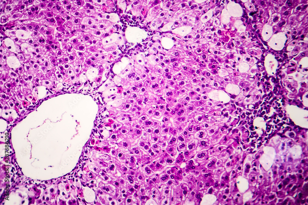 Histopathology of acute hepatitis, light micrograph, photo under ...