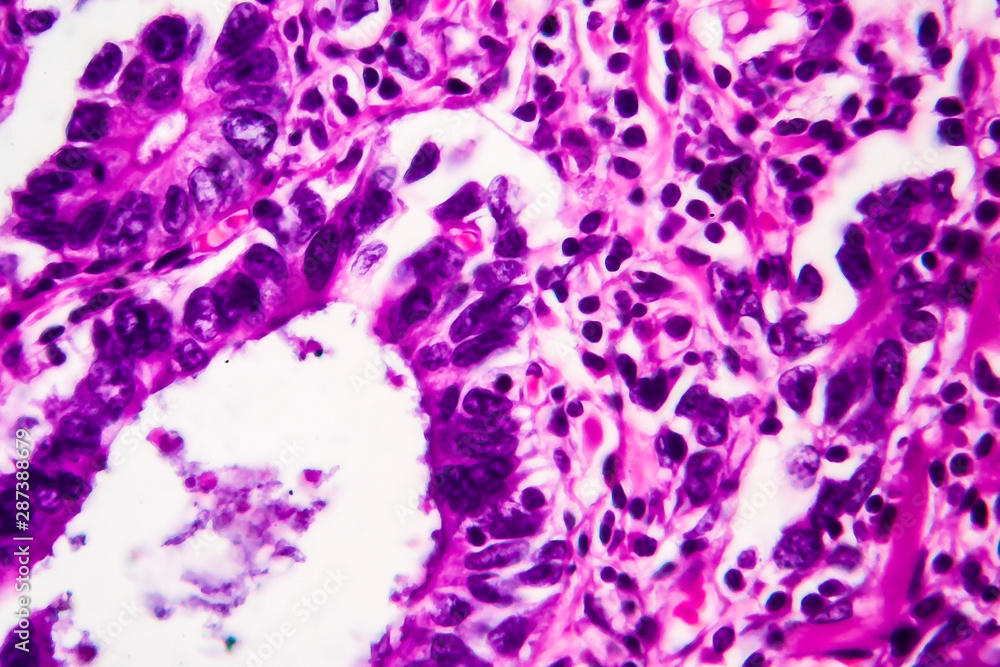 Gastric adenocarcinoma, light micrograph, photo under microscope. High ...