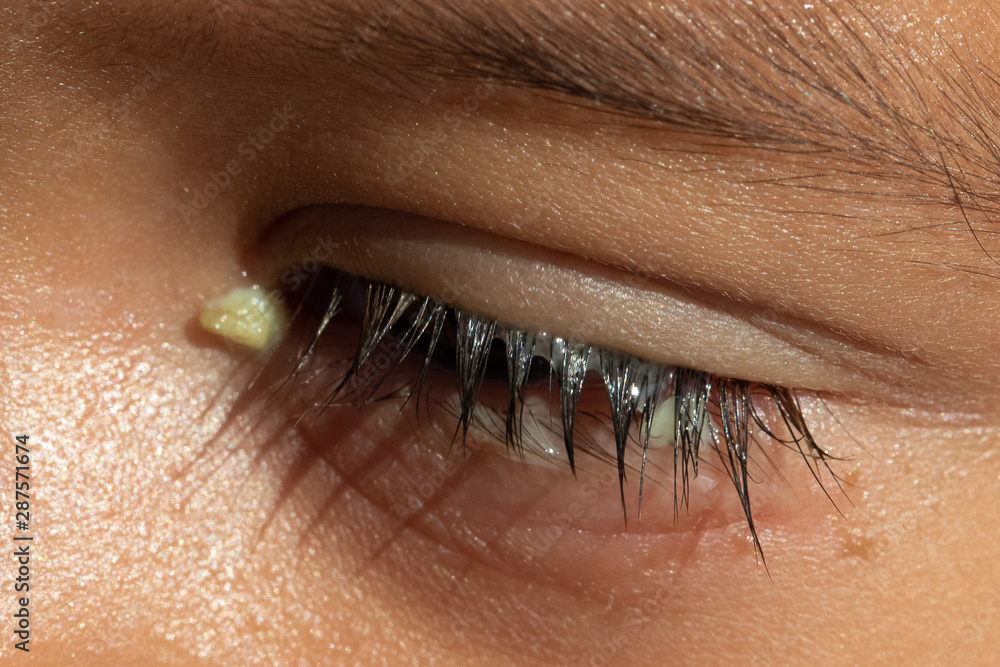 A macro view on the eye of a preschool boy, with red and puffy lower ...