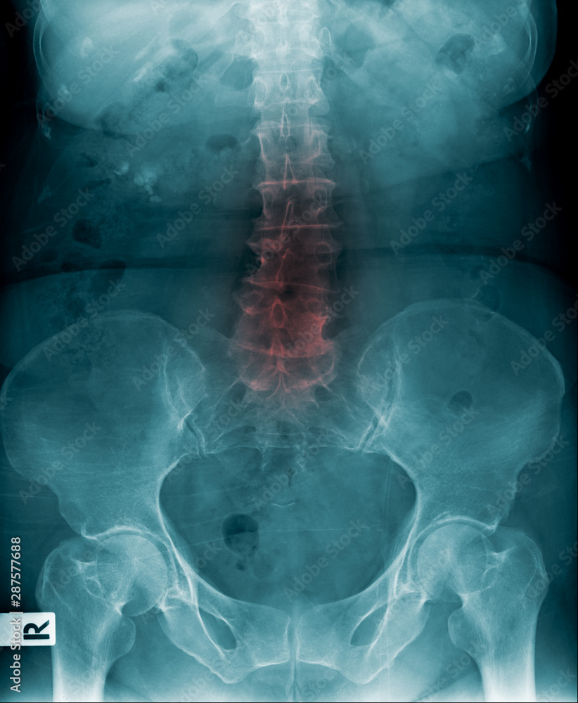 x-ray image lumbar spine and degenerative change of spine, l ...