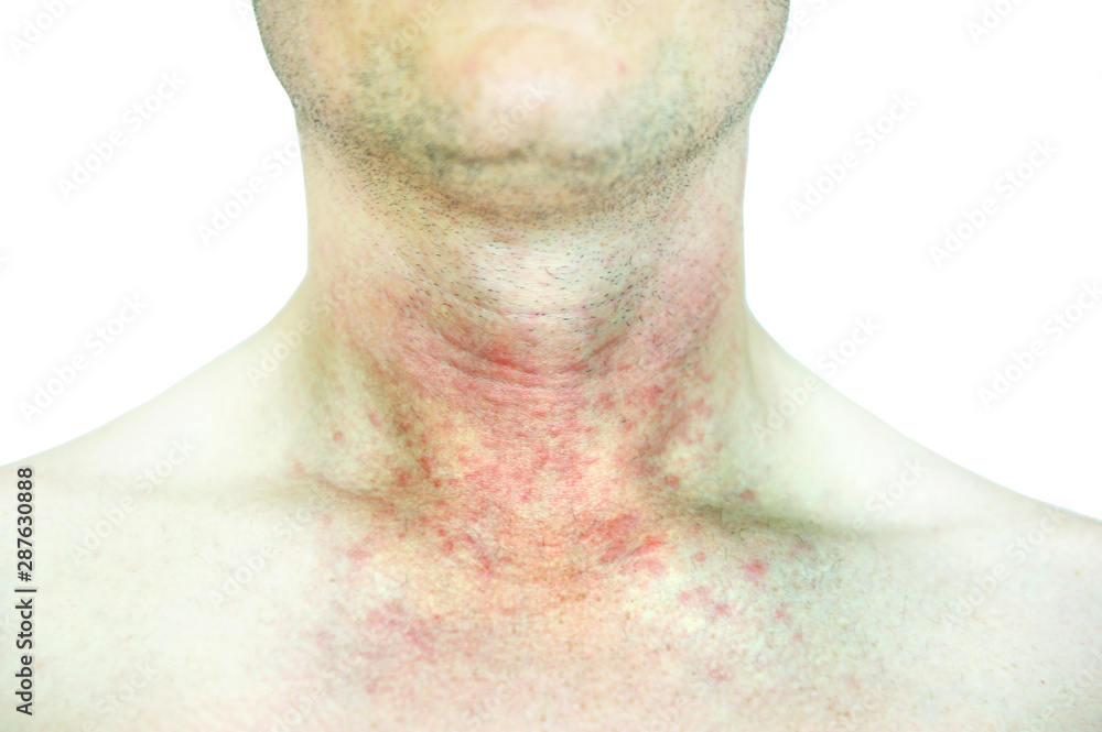Atopic dermatitis (AD), also known as atopic eczema, is a type of skin ...