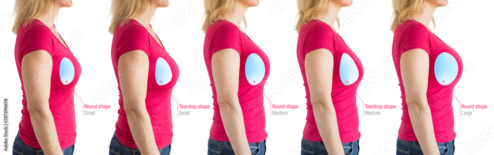 Choosing the right size of breast implants for desired look Stock Photo ...