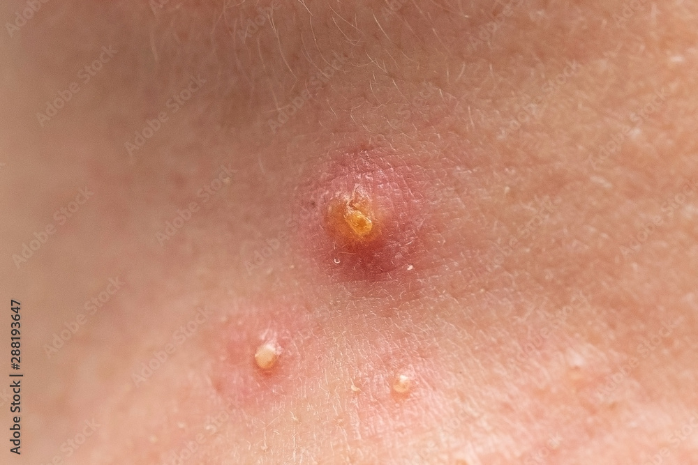 A close up view of pus filled spots on caucasian skin, clustered ...