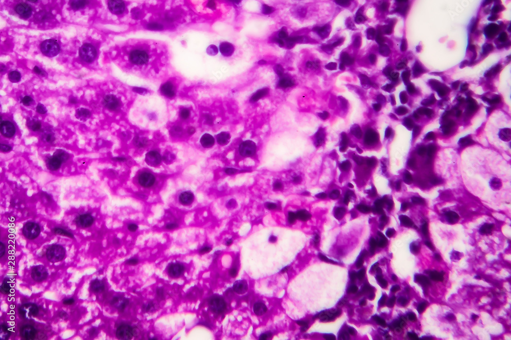 Histopathology of acute hepatitis, light micrograph, photo under ...