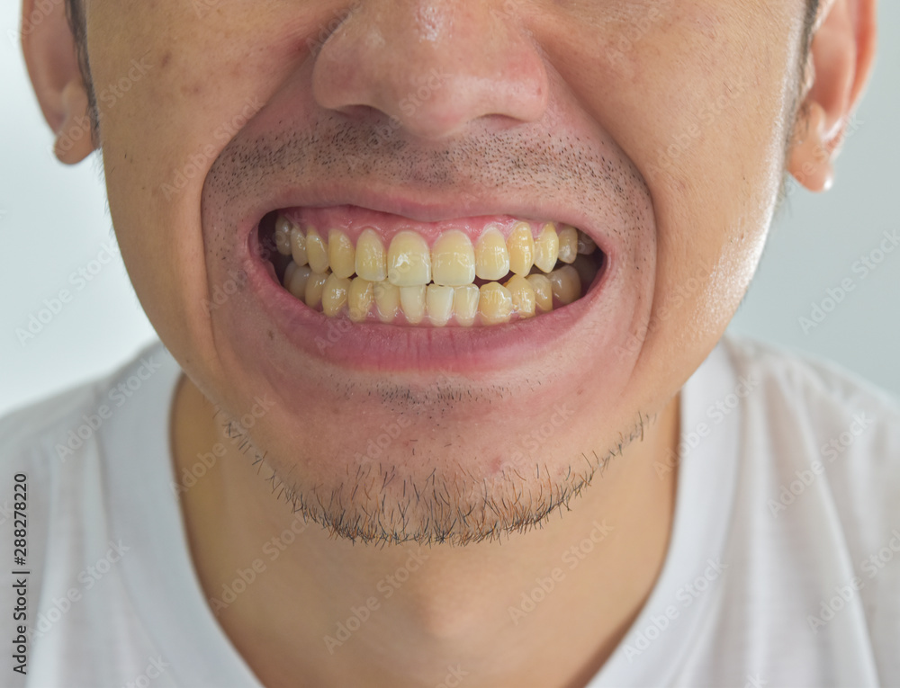 Close-up of yellow dirty teeth in male from smoke and coffee Stock ...