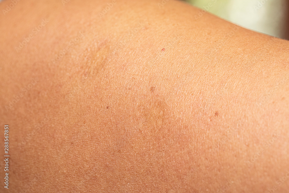 An extreme closeup view of aging caucasian skin, with sun spots, tags ...