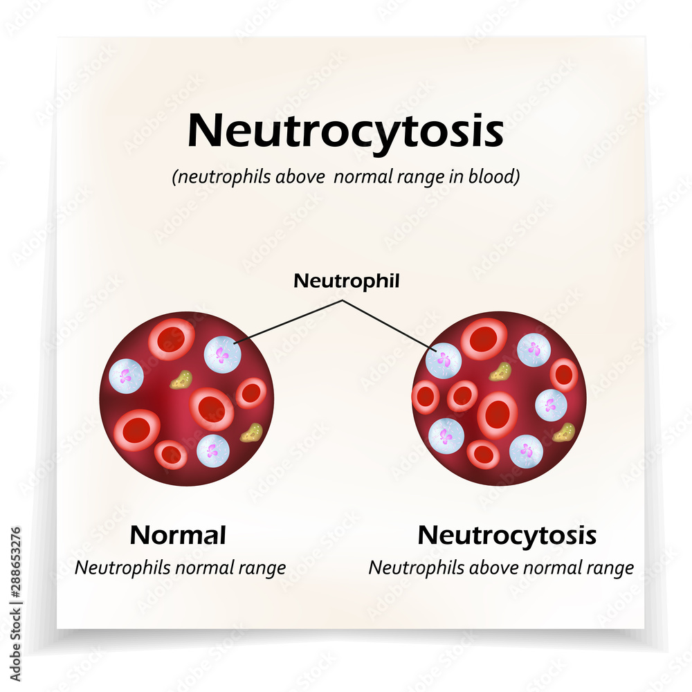 Neutrophils were above the normal range in the blood. Neutrocytosis ...