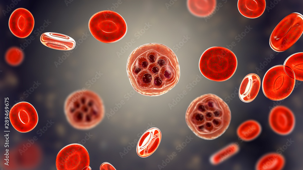 Red blood cells infected with malaria parasite, 3D illustration showing ...